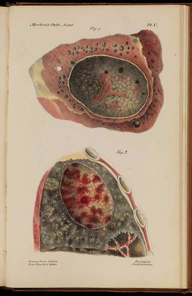 Romanticizing Death: Art in the Age of Tuberculosis