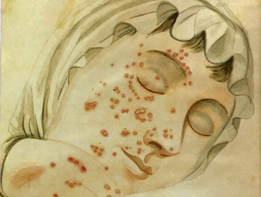 Smallpox in the New World: History, Victims, & Symptoms