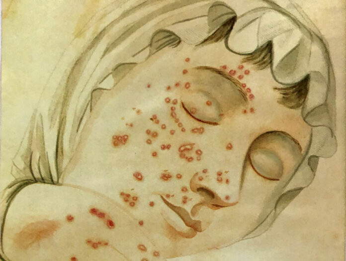 Smallpox in the New World: History, Victims, & Symptoms