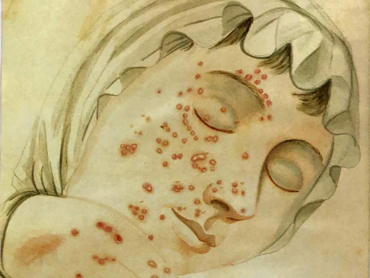 Smallpox in the New World: History, Victims, & Symptoms