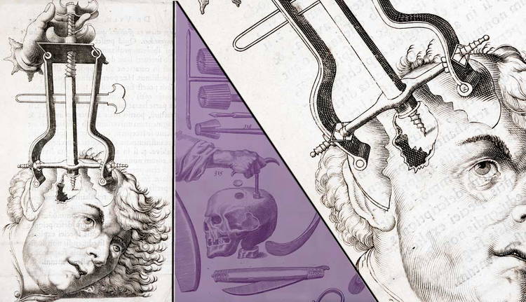 From Trepanation to Cosmetics: Mindboggling Ancient Surgeries