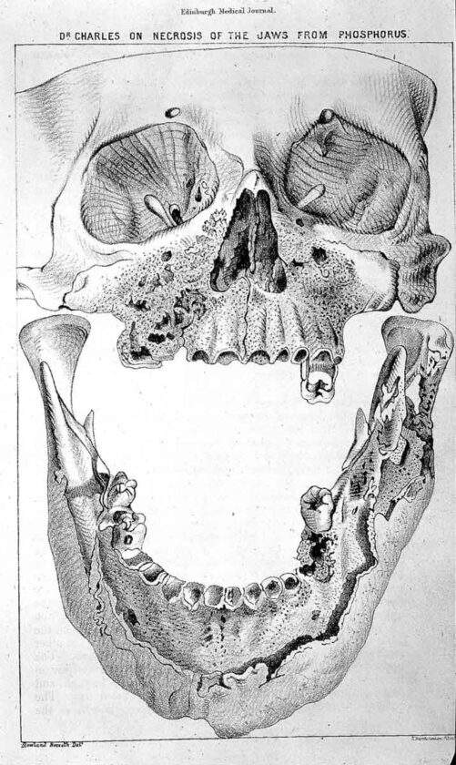 4 Diseases that Don’t Exist Anymore