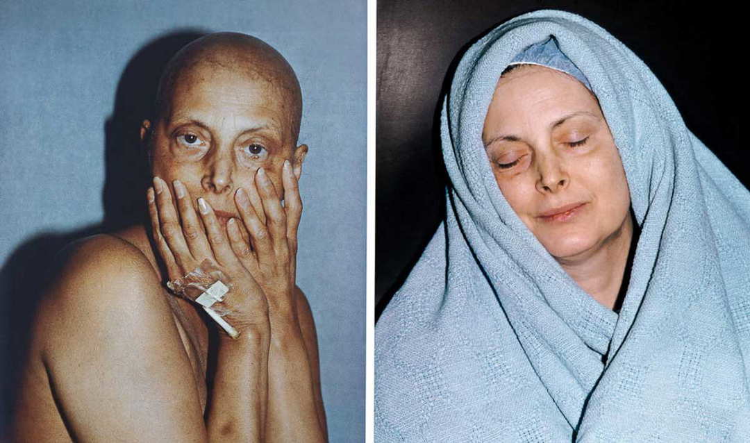 Why Is the Feminist Art of Hannah Wilke So Special?